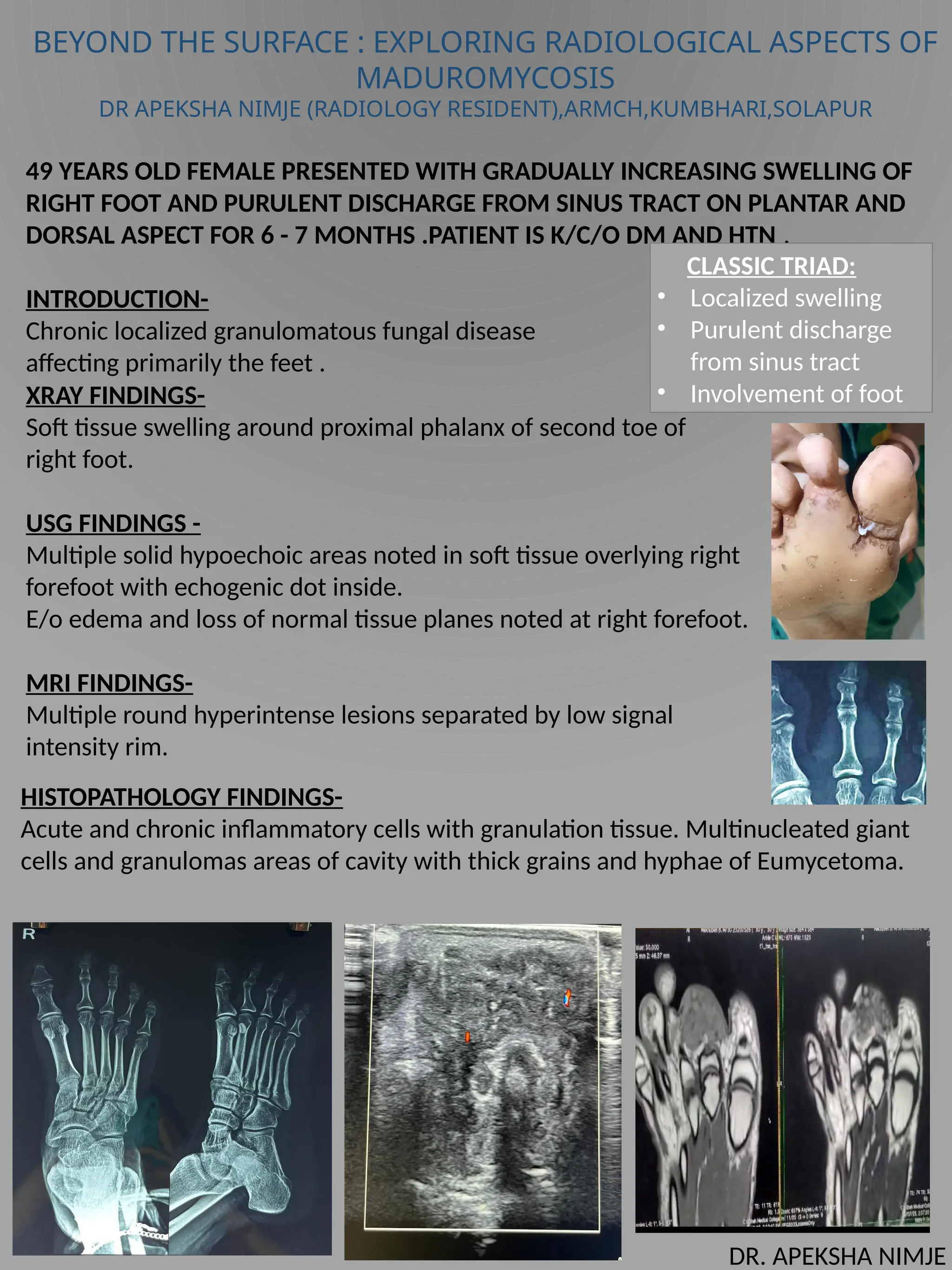 A case of madura foot also called as actinomycosis | PPTX