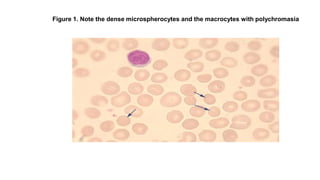 A Practical Approach to Anemia | PPT