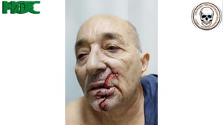 Cirurgia e Traumatologia Buco-Maxilo-Facial | PPTX