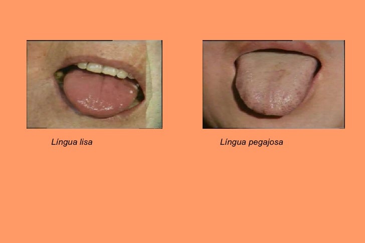 Jihva Parishka - Diagnóstico pela Língua