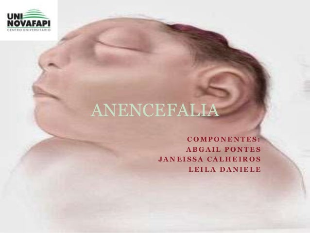 Anencefalia