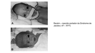 sindrome de jacobs | PPTX