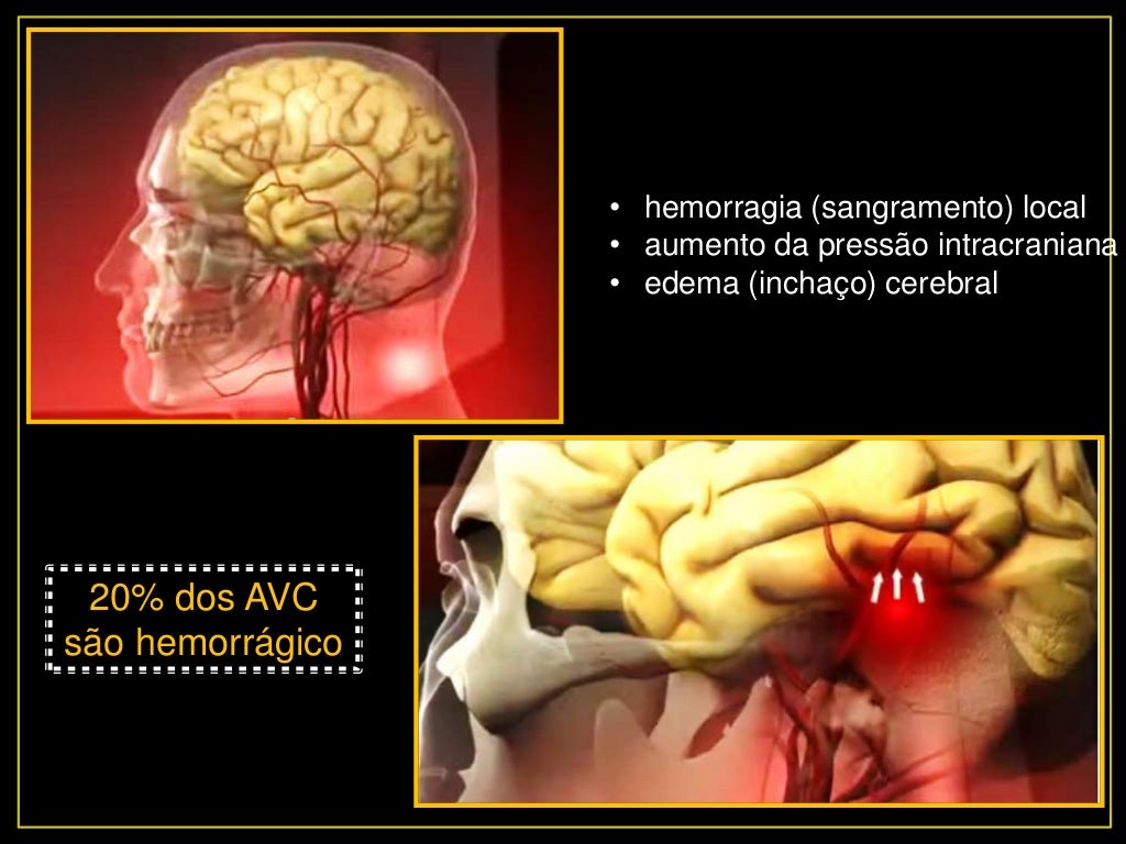 AVC- Acidente Vascular Cerebral
