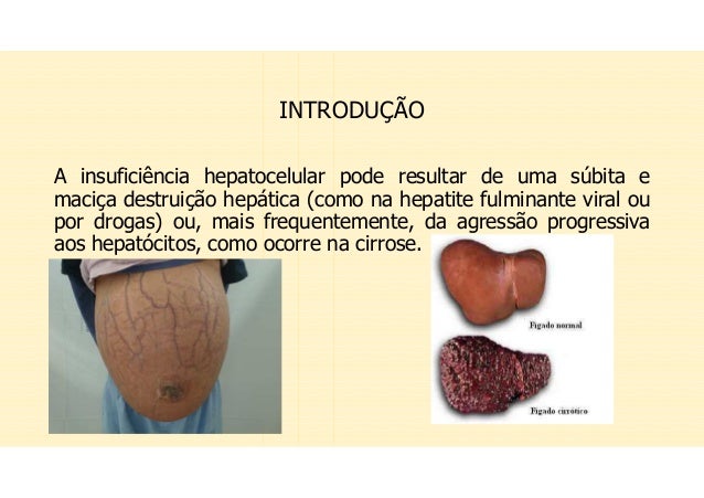 Sintomas De Cirrose Hepatica Coceira