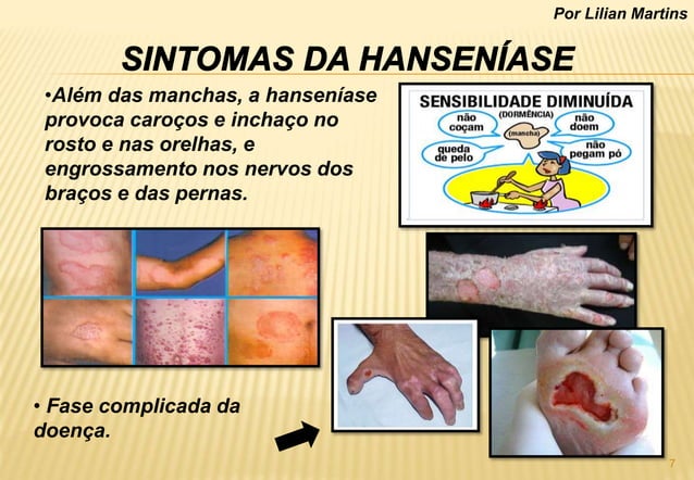 Hanseníase - Trabalho de microbiologia slides