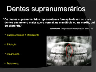 Alterações associadas a dentes supranumerários inclusos | PPTX