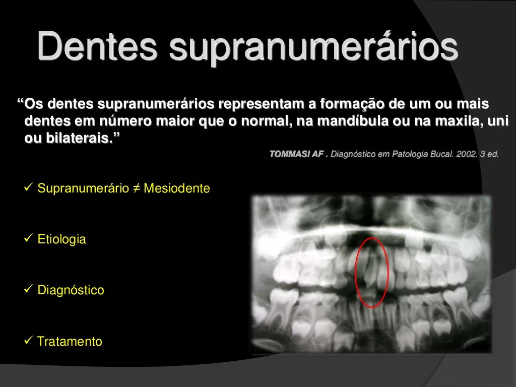 Alterações associadas a dentes supranumerários inclusos