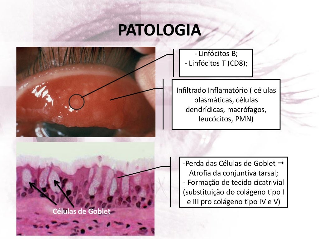 Apresentação tracoma atualizado