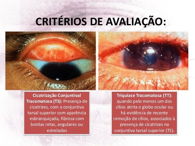 Apresentação tracoma atualizado