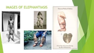 A presentation on Elephantiasis.pptx