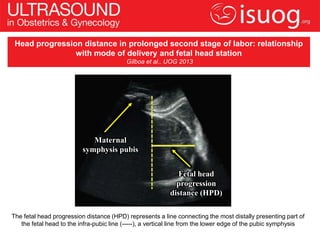 UOG Journal Club: Intrapartum transperineal ultrasound assessment of ...