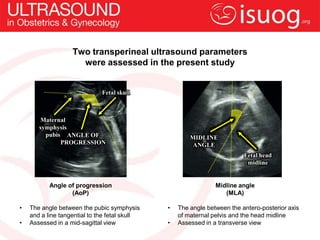 UOG Journal Club: Intrapartum transperineal ultrasound assessment of ...