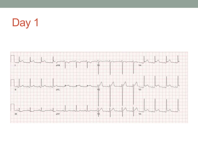 EKG Of The Month April 2017 | PPT