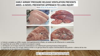 APRV ventilación con liberación de presión de la vía aérea .pptx