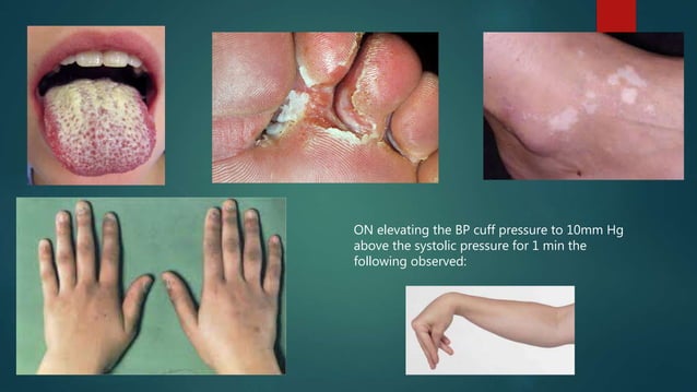 Autoimmune polyendocrine syndromes (APS)pptx | PPT