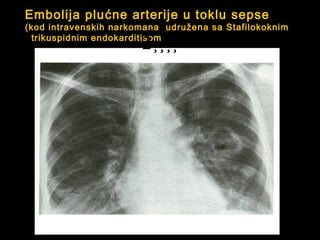Apsces pluca | PPT