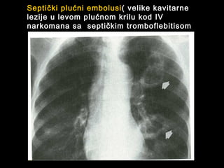 Apsces pluca | PPT
