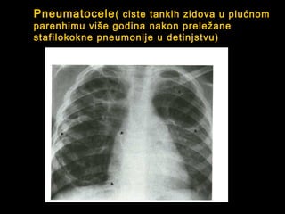 Apsces pluca | PPT
