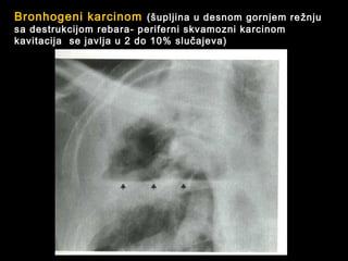 Apsces pluca | PPT