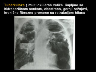 Apsces pluca | PPT