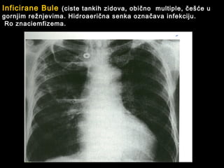 Apsces pluca | PPT