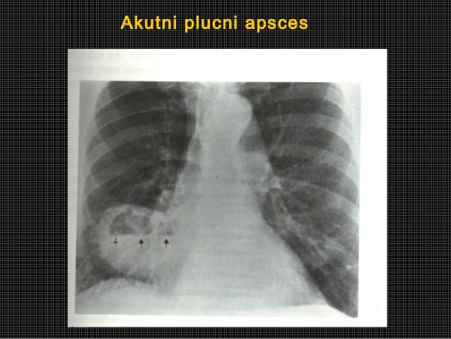 Apsces pluca
