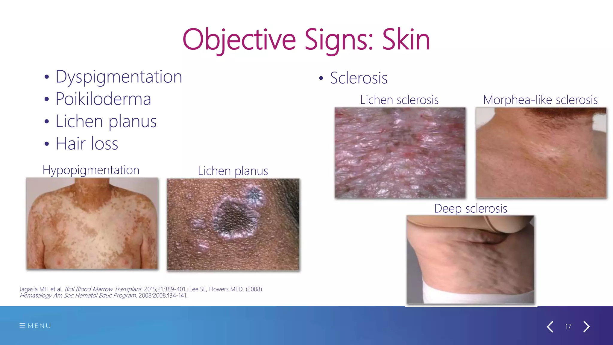 Understanding Chronic Graft-vs.-Host Disease | PPTX