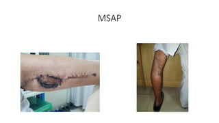 relevance of RAFF in present day head and neck reconstruction.pptx