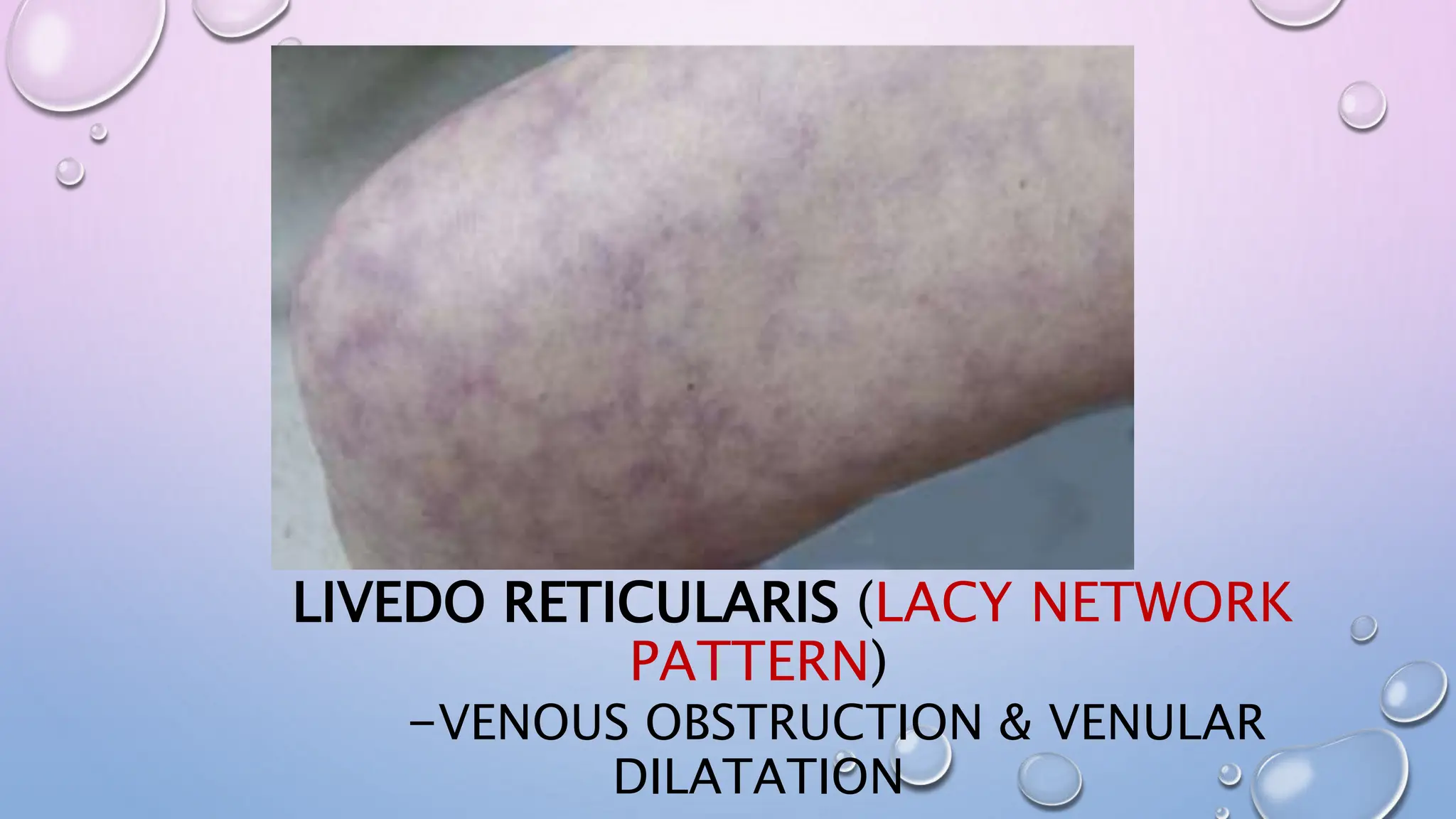 Antiphospholipid syndrome - diagnosis RX | PPTX