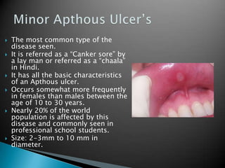 Management and Treatment of Recurrent Apthous ulcer’s | PPTX