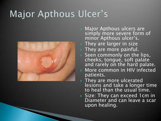 Management and Treatment of Recurrent Apthous ulcer’s | PPTX