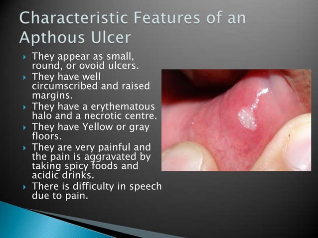 Management and Treatment of Recurrent Apthous ulcer’s | PPT