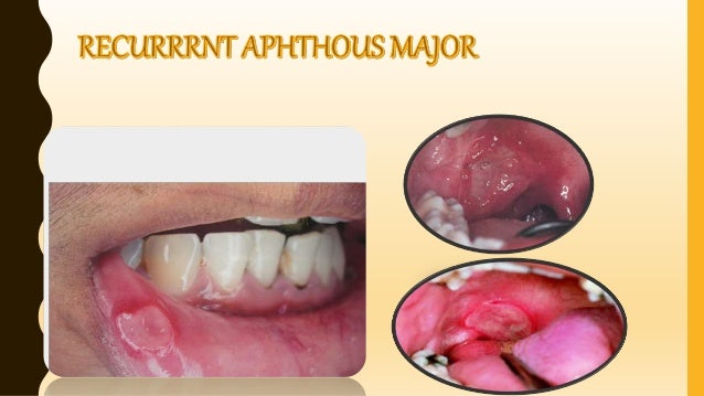 Aphthous ulcers