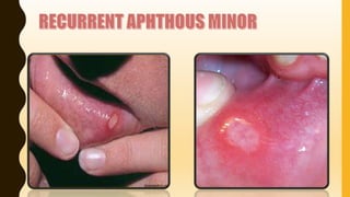 Apthous ulcers | PPTX