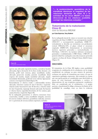 Tratamiento de la maloclusión clase III con la técnica MEAW | PDF