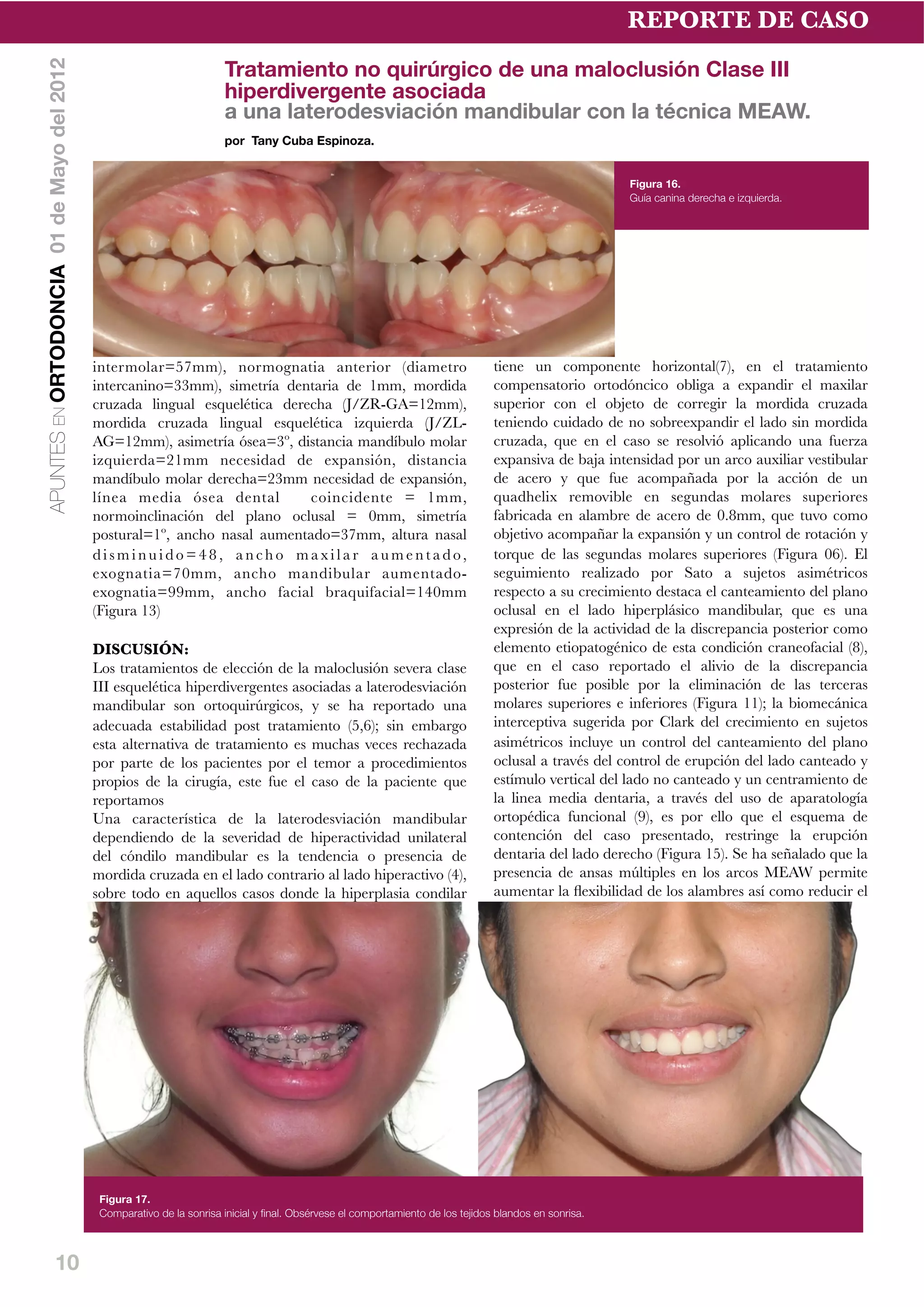 Tratamiento no quirurgico de una maloclusion clase III hiperdivergente ...