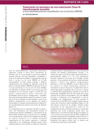 Tratamiento no quirurgico de una maloclusion clase III hiperdivergente ...