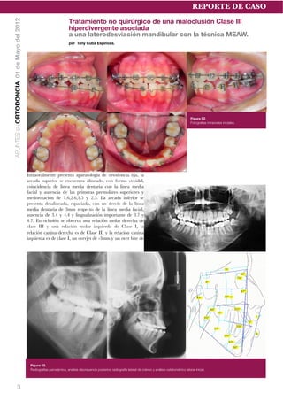 Tratamiento no quirurgico de una maloclusion clase III hiperdivergente ...