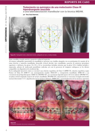 Tratamiento no quirurgico de una maloclusion clase III hiperdivergente ...