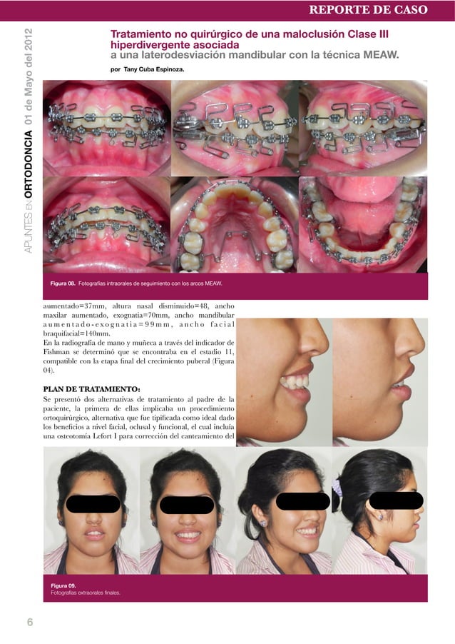 Tratamiento no quirurgico de una maloclusion clase III hiperdivergente ...