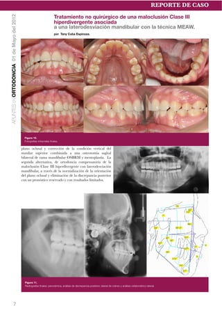 Tratamiento no quirurgico de una maloclusion clase III hiperdivergente ...