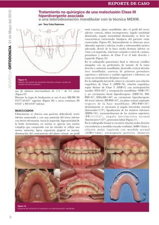 Tratamiento no quirurgico de una maloclusion clase III hiperdivergente ...