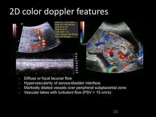 Morbidly Adherent Placenta (for APAN39) | PPTX