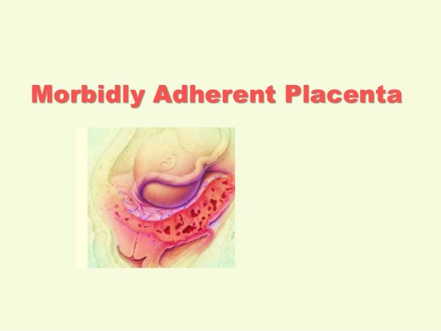 Morbidly Adherent Placenta For Apan39