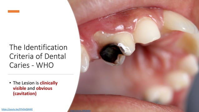 DMFT Index | PDF | Dental Health | Diseases and Conditions