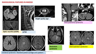 Neuromyelitis optica spectrum disorder -NMOSD : An AQP4 antibody illness | PPTX