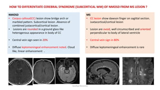 Neuromyelitis optica spectrum disorder -NMOSD : An AQP4 antibody ...