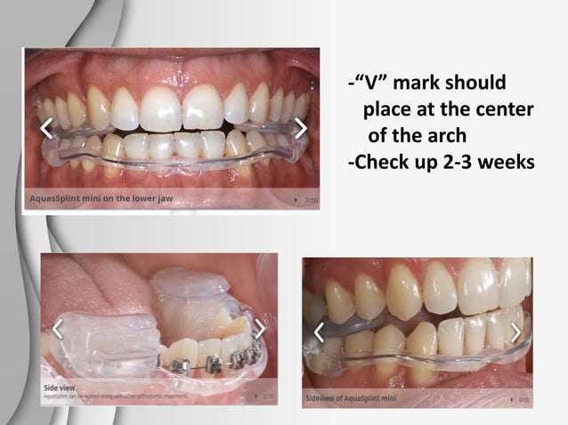 Aqua Splint universal therapy tmj orthodontics.pptx