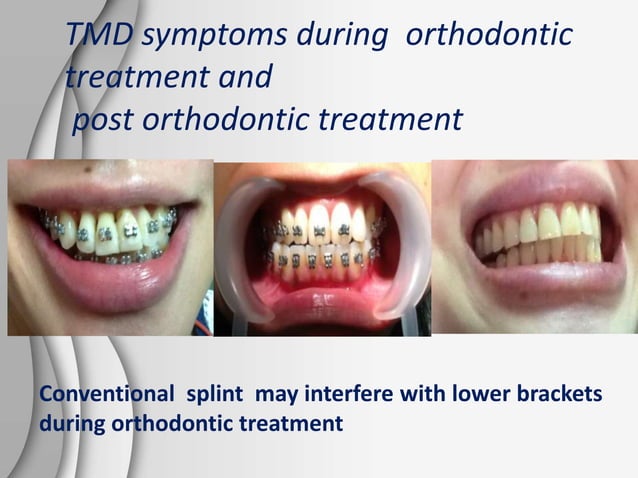 Aqua Splint universal therapy tmj orthodontics.pptx