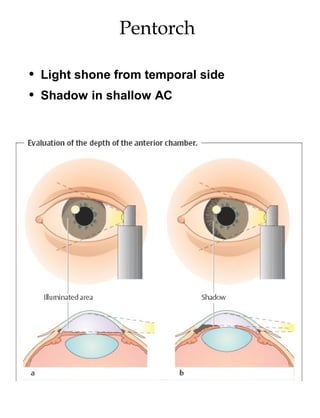 Aqueous humor,anterior chamber angle and its examination. | PPT